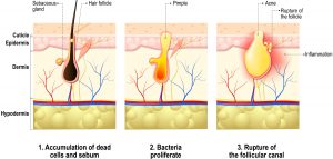 Exeter Acne diagnosis & treatments