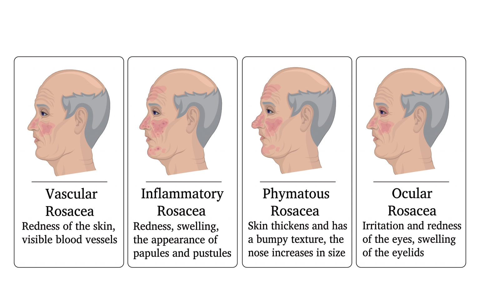 Rosacea skin treatment in Exeter & Torquay in Devon.