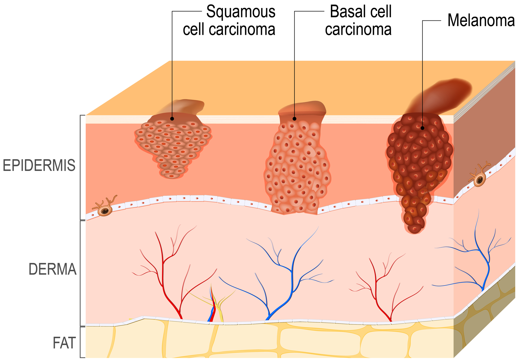 Skin Cancer treatment in Exeter & Torquay in Devon.