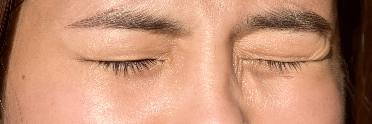 Blepharospasm Botox Before And After